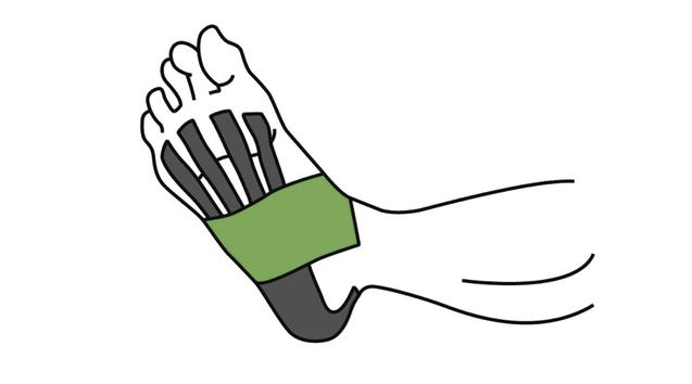 Treating Plantar Fasciitis